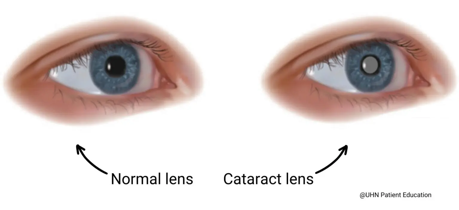 Cataract surgery: 5 do’s and don’ts – UHN Foundation